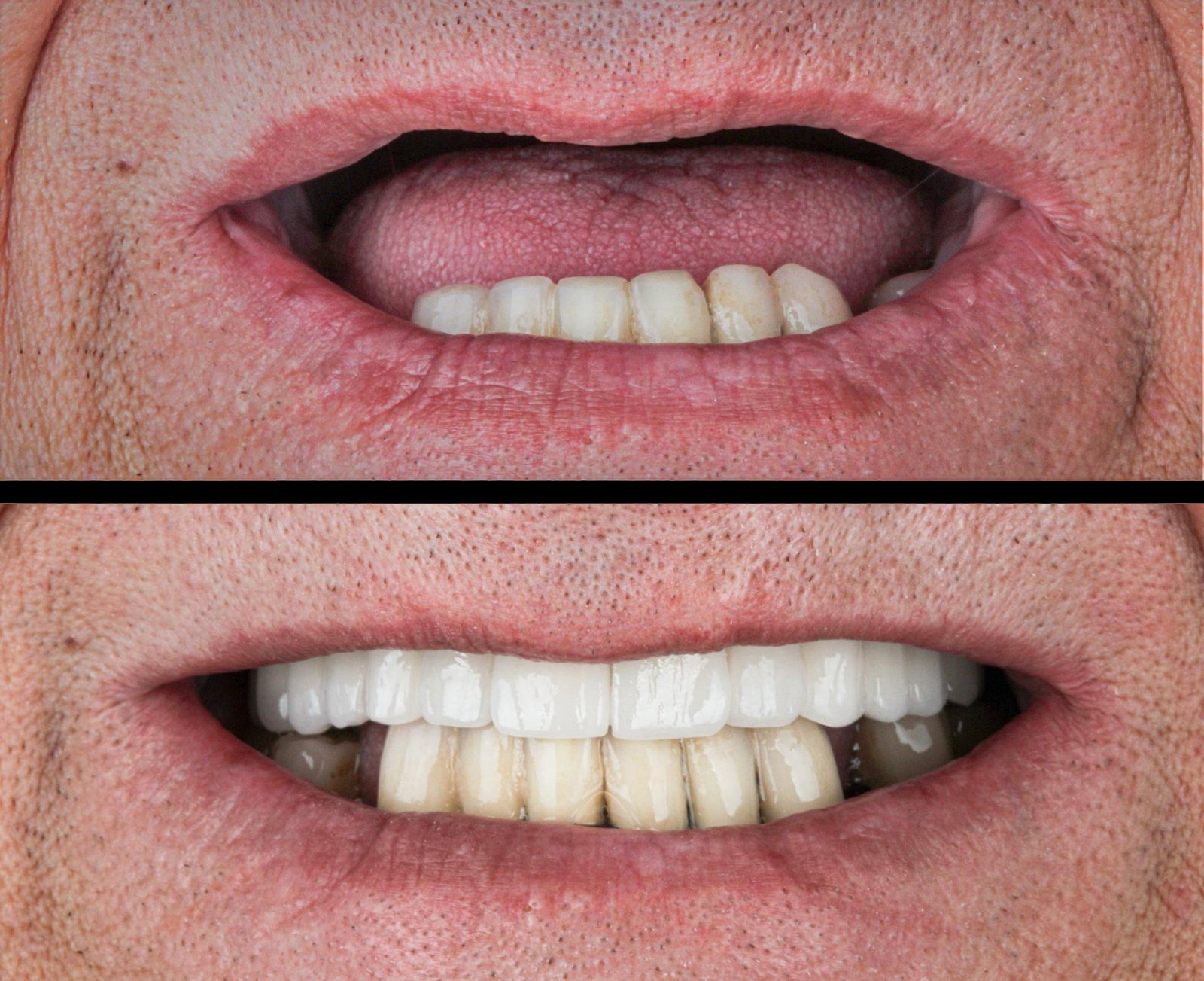 Offer Implant - Burwood Diamond Dental